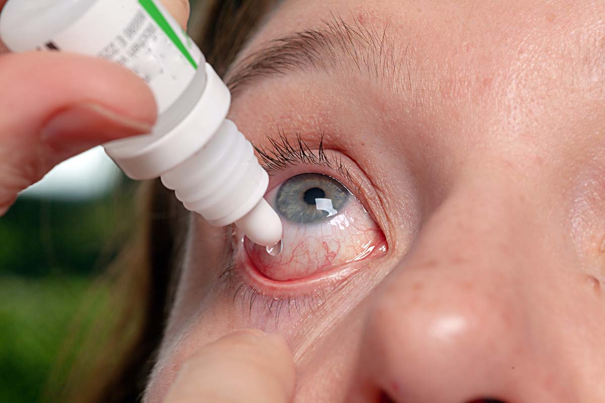 Conjunctiva Conditions - Port Elizabeth Eye and Laser Institute
